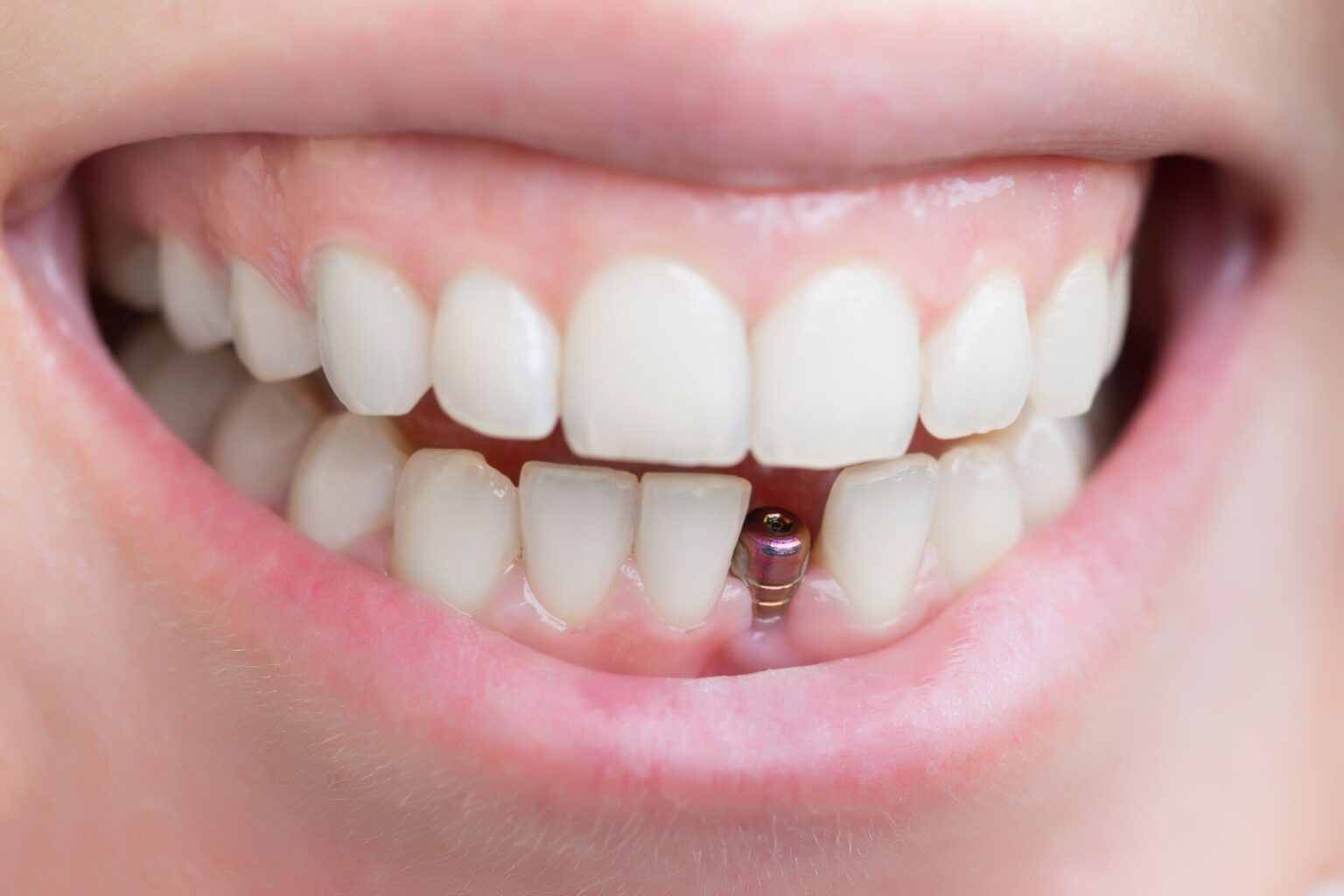 Dental Implants Middlesbrough That Look and Feel Like Natural Teeth